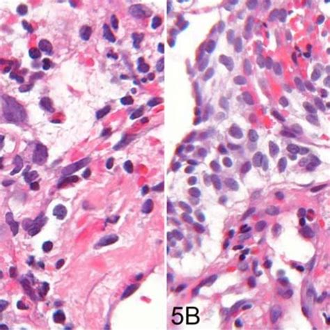 Postoperative Spindle Cell Nodule The Submucosal Nodule Consists Of Download Scientific