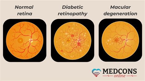 Retinal Diseases Development Factors And And Modern Treatment Options