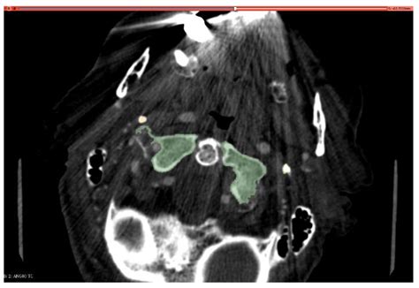 Cta Segmentation Using Threshold Selector Download Scientific Diagram