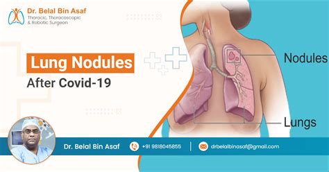 When To Worry About Lung Nodules Dr Belal Bin Asaf
