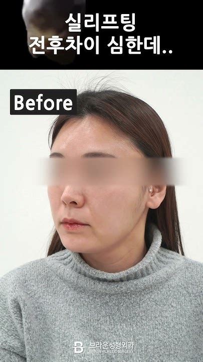 실리프팅 전후차이 심각하다 실리프팅 실리프팅효과 실리프팅잘하는곳 팔자주름 브이라인 성형후기 전후사진 치피치피 Plasticsurgery Kbeauty