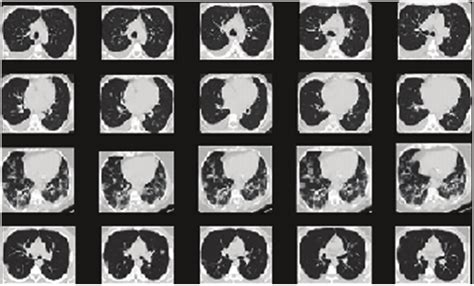 Sample Image From Dataset Sars Cov 2 Download Scientific Diagram