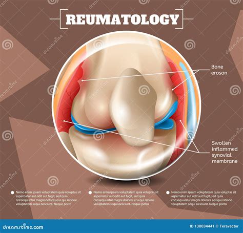 Types Of Synovial Joints Movement Classification For Body Outline Diagram Cartoon Vector