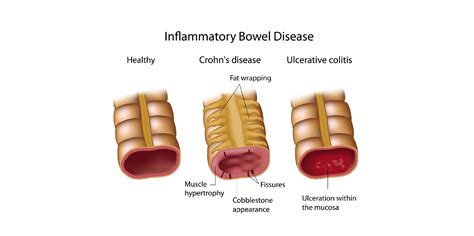 Inflammatory Bowel Disease Diagnostics Mims Malaysia