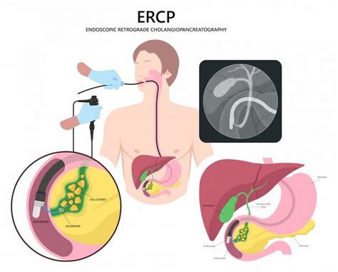 Ercp And Papillotomy Find A Specialist Leading Medicine Guide
