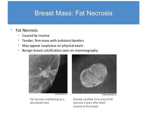 Breast Disorders2 8 11
