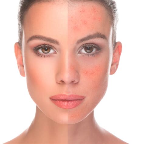 Diffuse Rednessbroken Capilleries Jules Stellan Medispa