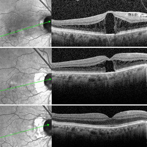 Sd Oct Scans Of Patient 7 Top Preoperative Sd Oct Shows Outer