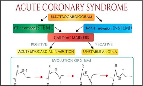 Acute Coronary Syndrome Causes Risk Factors Symptoms Treatment