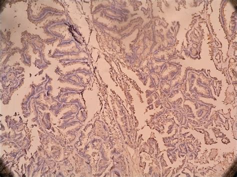 Choroid Plexus Carcinoma In An Adult Journal Of Neurosciences In