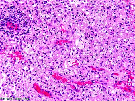 Tumefactive Demyelination Hande Stained Slide X 200