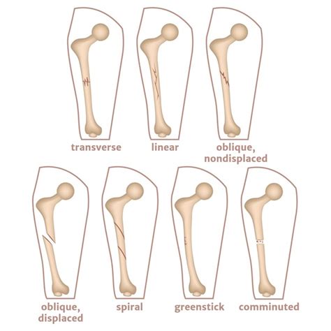 179 Oblique Fracture Stock Vectors And Vector Art Shutterstock
