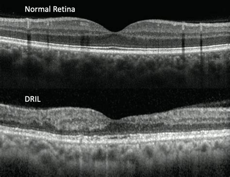 Tips For Recognizing And Understanding Oct Biomarkers Modern Optometry