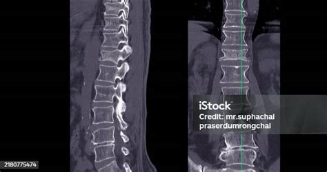 Spinal Compression Fracture At L1 Level Lumbar Ct Scan A Detailed Ct