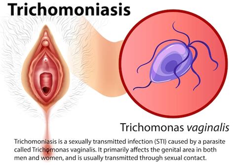 Free Vector Trichomoniasis Infographic With Explanation