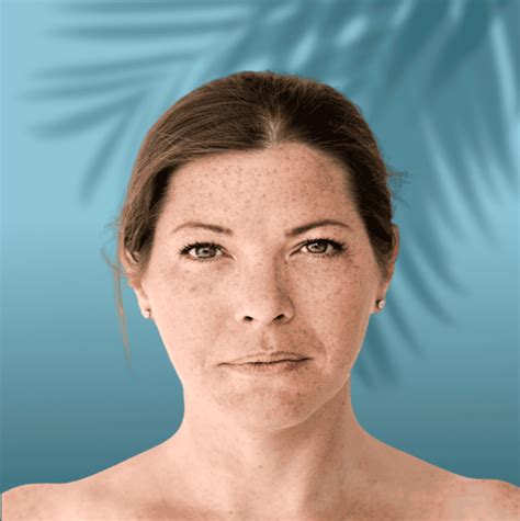 Hyperpigmentation Causes Treatment And Solutions