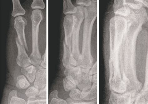 Metacarpal Fractures Musculoskeletal Key