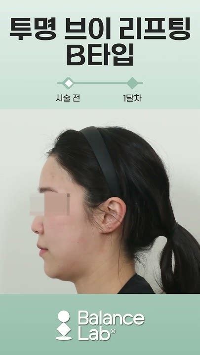 투명브이리프팅 B타입 1달차 🤩 실리프팅 실리프팅후기 실리프팅전후 리프팅 투명브이리프팅 밸런스랩성형외과 Youtube
