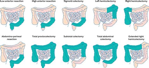 Open Colectomy Procedures