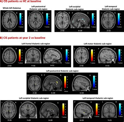 Sub Regional Left Thalamic Resting State Functional Connectivity Download Scientific Diagram