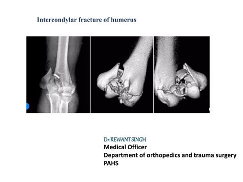Intercondylar Fracture Of Humerus Pptx