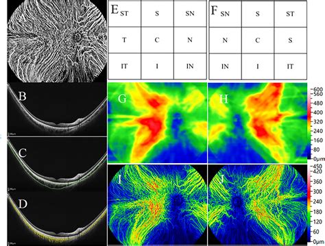 Figure 1 From Diurnal Variation In Choroidal Parameters Among Healthy Subjects Using Wide Field