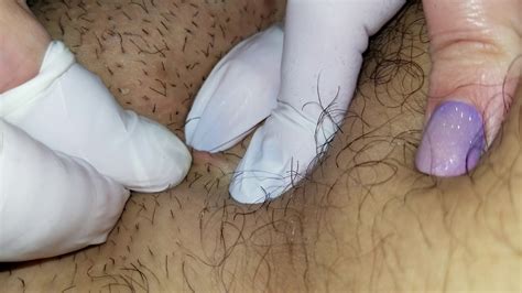 Pimple Popping For Pleasure In Groin Area YouTube