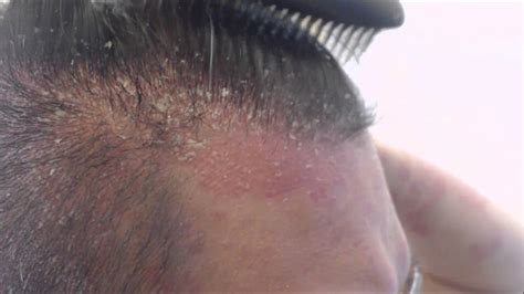 Itchy Scalp Hair Loss Causes And Treatments Hairguard
