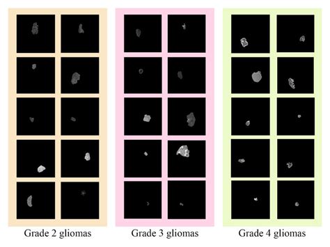 Extracted Tumor Areas As Input Images To The Deep Convolutional Neural