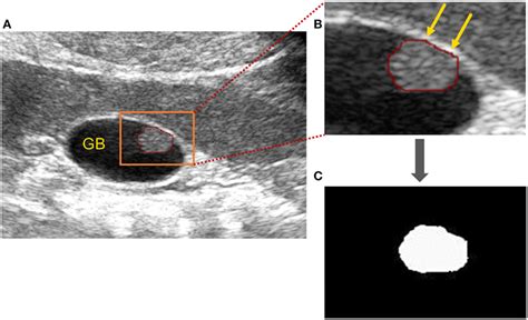 Image Processing Of Gallbladder Cholesterol Polyps A Original Download Scientific Diagram