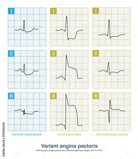 Different Types Of Angina Pectoris Have Different Ecg Patterns