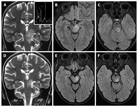 Brainstem Encephalitis Fatal Subacute Cytomegalovirus Encephalitis