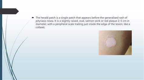 Pityriasis Pptx