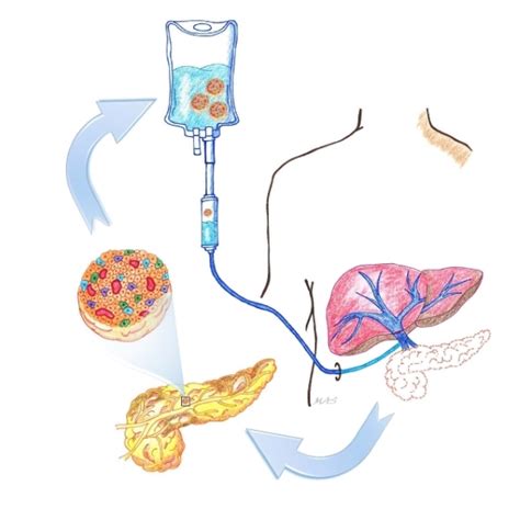 Total Pancreatectomy with Islet Autotransplant | Total Pancreatectomy ...