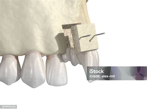 뼈 이식 뼈 치아 이식의 블록을 사용하여 확대 의학적으로 정확한 3d 일러스트레이션 감소에 대한 스톡 사진 및 기타 이미지