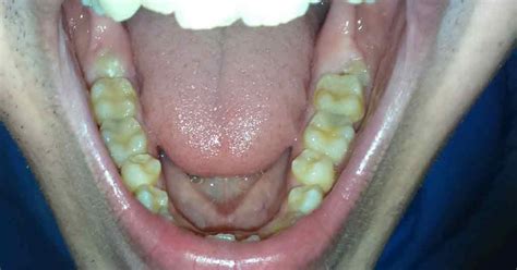 People Without Tongues