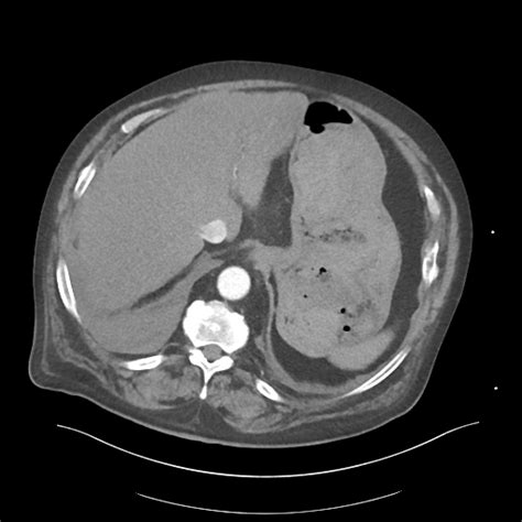 Bleeding Peptic Ulcer Radiopaedia 42912 46142 A Nc Commons