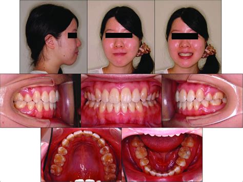 Effectiveness Of Low Binding Frictional Materials Evaluation Of The