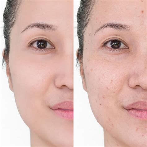Tretinoin Cream Before And After Acne