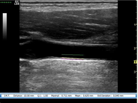 Assessment Of Carotid Imt Measurement Of The Imt In The Far Wall Of Download Scientific