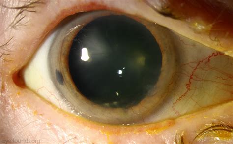 Subepithelial Infiltrates Cornea