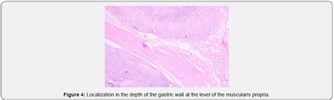 Juniper Publishers Journal Of Case Studies Case Report A Rare Case Of