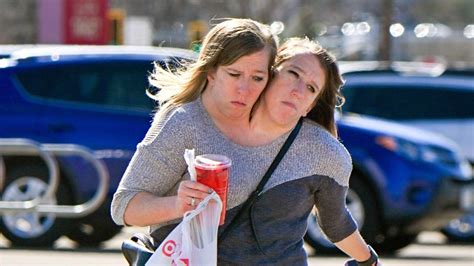 Conjoined Twins Separated