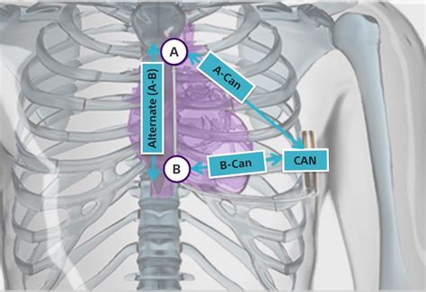Emblem™ Mri S Icd Subcutaneous Technology Boston Scientific