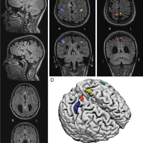 preoperative structural and motor task based fmri download scientific