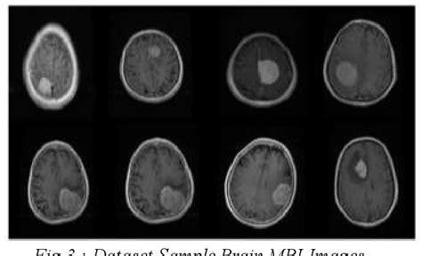 Figure 1 From Image Segmentation Using Mask R Cnn For Tumor Detection
