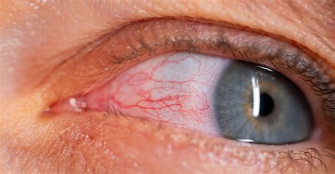 What Is Ocular Herpes And How Is It Treated