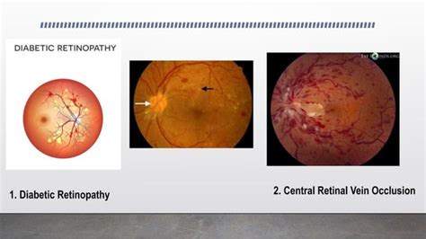 This Is A Case Of Neovascular Glaucoma Pptx