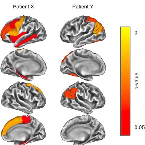 Vertex‐wise Correlations Between Cortical Thickness And Severity Of