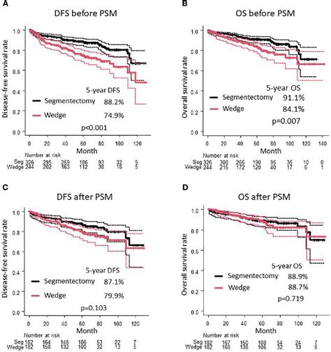 Figure 2 From Wedge Resection Vs Segmentectomy For Lung Cancer
